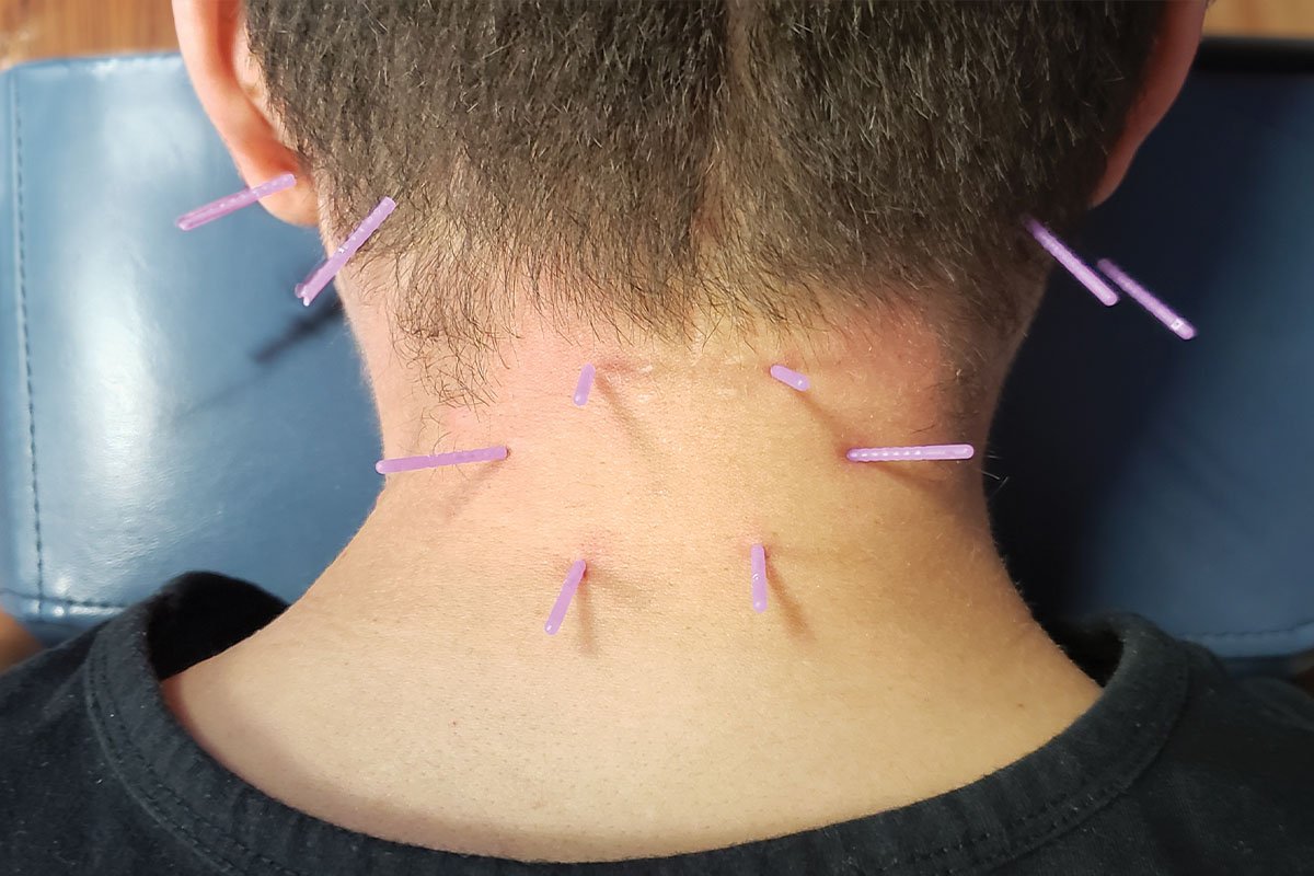 Dry Needling and the Neck: What to Expect - ForthWorthHeadNeckandJaw
